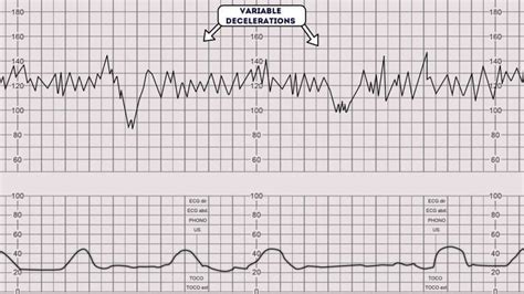 How To Read A Ctg Geeky Medics Eco Eco