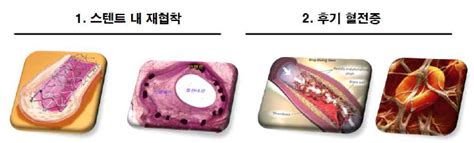 보고서 폴리머기반 다중 약물용출 스텐트와 비폴리머기반 약물용출 스텐트의 제작 및 전임상평가