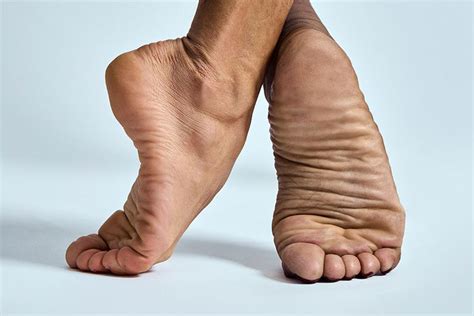 Hollow Foot Pes Cavus Orthotics Tread Labs