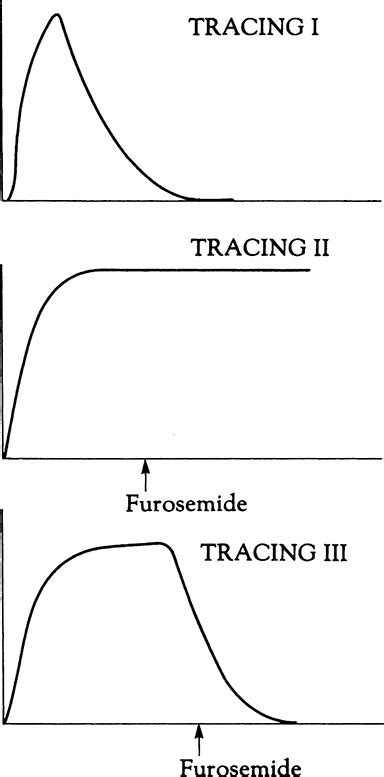 Obstructive Nephropathy Pathophysiology And Management Abdominal Key