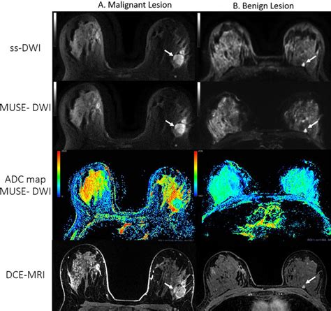 high spatial resolution multishot multiplexed sensitivity encoding diffusion weighted imaging
