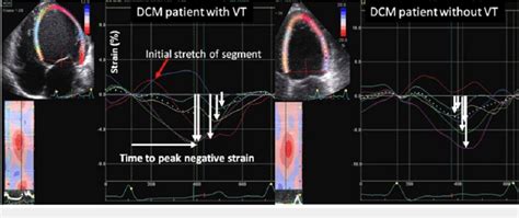 Figure Showing Longitudinal Myocardial Deformation In Patient With