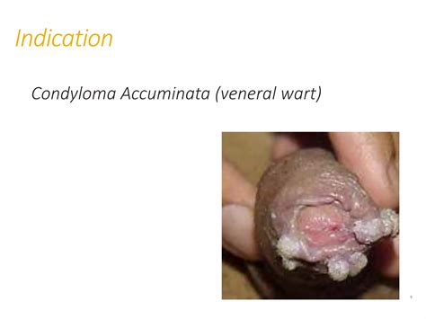 Basic Technique Of Circumcision By Regi Septian Ppsx