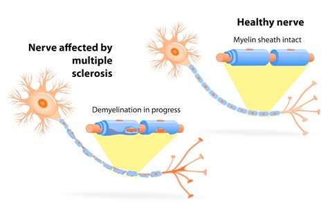 Multiple Sclerosis Myelin