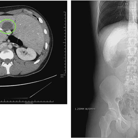 Abdominal CT Axial View Showing A Mid Pelvic Appendix That Is Download Scientific Diagram