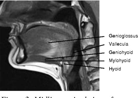 Figure 2 From Atlas Of Otolaryngology Head And Neck Operative Surgery Total Glossectomy For