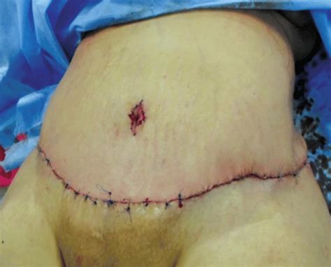 Early Post Operative Download Scientific Diagram