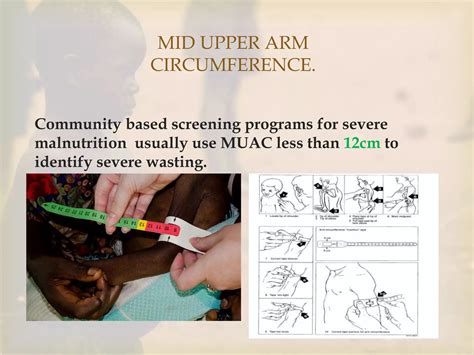 Malnutrition Classification And Severe Malnutrition Management Pptx