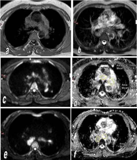 A Axial T1wi B Axial T2wi C E Diffusion Weighted Mri Image D F Adc Download Scientific