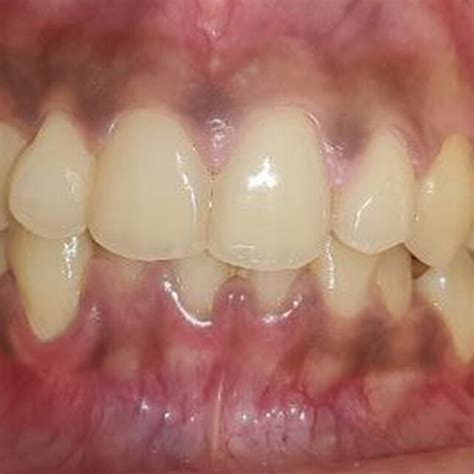 Association Of Gingival Pigmentation With Gingival Biotype Download