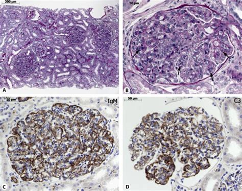 Renal Biopsy Findings In A Patient With A Cryoglobulin Induced Immune