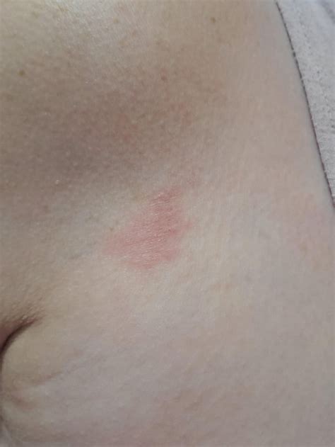 Scaly Patch On Skin Rdermatologyquestions