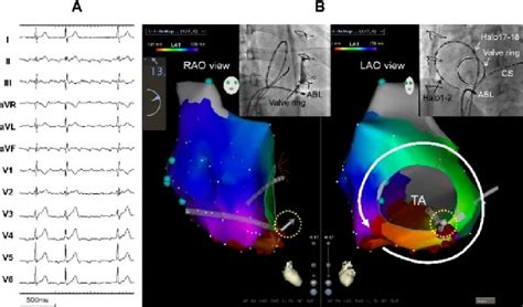 Figure 2 From Successful Ablation Of Cavotricuspid Isthmus Dependent Atrial Flutter Guided By