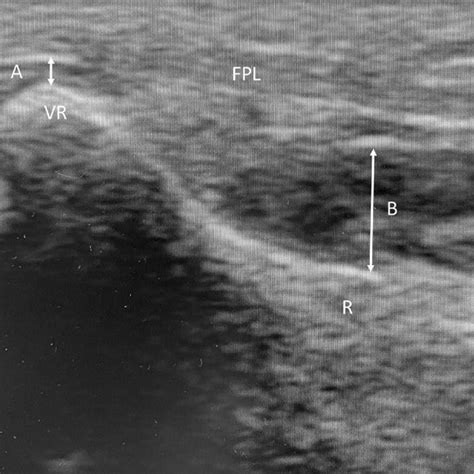 Soong Classification Soong Grade 0 The Plate Is Dorsal To The Volar Download Scientific