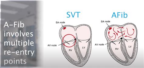 Adenosine Injection Acls Drugs Svt Adenosine Dosing Acls Certification Association