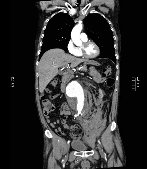 Abdominal Aortic Aneurysm Rupture