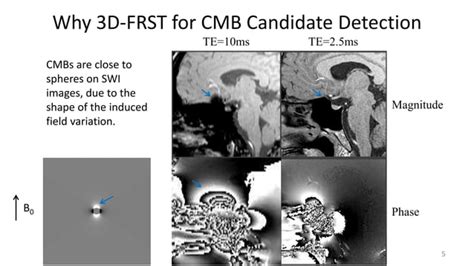 Cerebral Microbleed Detection Using Susceptibility Weighted Imaging And