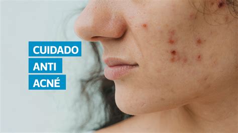 Video Acné Causas Síntomas Y Tratamientos Efectivos Según