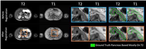 논문 리뷰 Influence of Early through Late Fusion on Pancreas Segmentation from Imperfectly