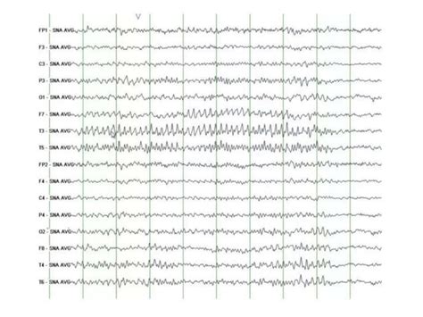 Normal Eeg Variants By Faizan Abdullah PPT