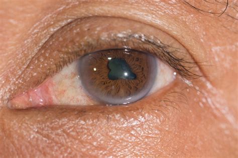 What Are Cataracts And How Can They Be Treated