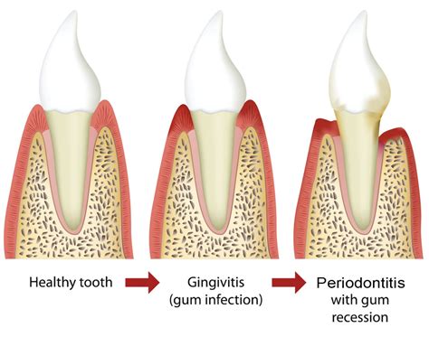 Gum Disease Dentist In Charlotte Nc Dentistry Of The Queen City