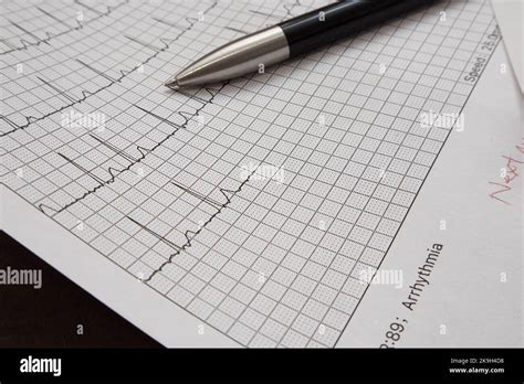 Electrocardiogram Ecg Or Ekg Presenting Possible Arrhythmia Stock