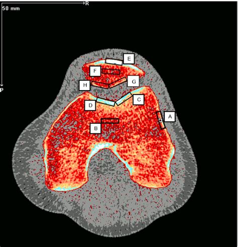 Subchondral Bone Density Regions Of Interest As Derived From The Pqct Download Scientific