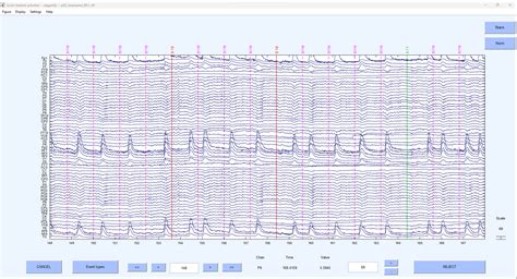Eeg Analysis Filtering
