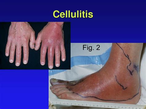Ppt Surgical Infections Powerpoint Presentation Free Download Id