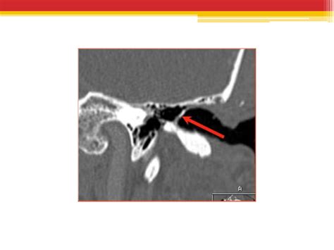 Tympanosclerosis Pptx