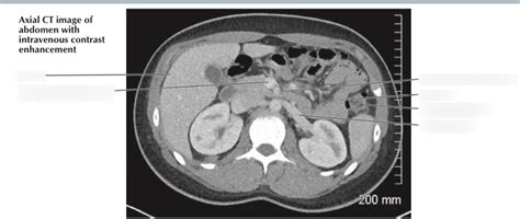 Diagram Of Ct Abdomen Hotspot Quizlet