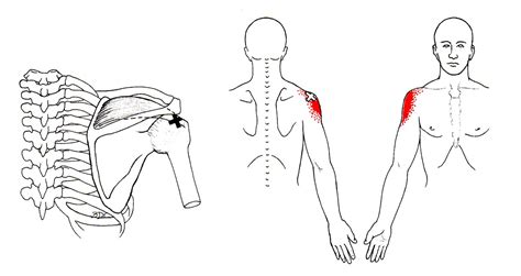 Supraspinatus Trigger Point