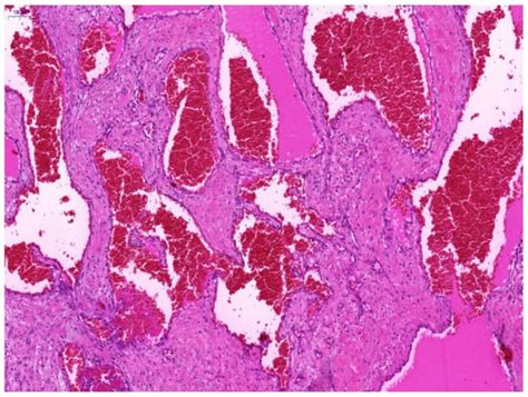 C Kit Expression In Orbital Cavernous Venous Hemangiomas