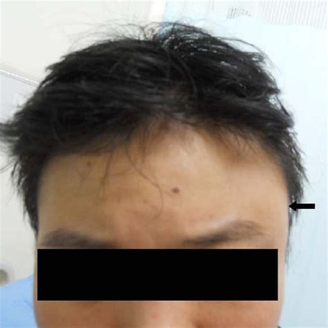 An Irregular Mass On The Left Forehead Black Arrow The Size Is About
