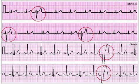 Pvcs Abnormal Heart Rhythm Charts