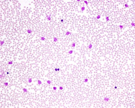 Ash 2024 Advances In Cll Sll Cancer Therapy Advisor