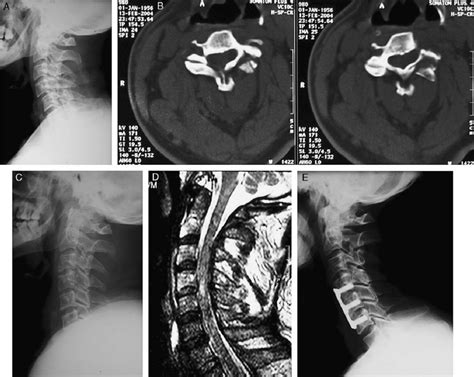 A And B Unilateral Facet Fracture Dislocation At The C4 C5 Level In A
