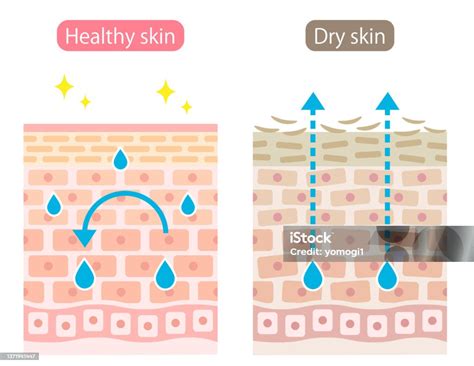 건조하고 건강한 피부 세포 층 일러스트 피부로부터의 수분 증발 뷰티 및 스킨 케어 컨셉 거친에 대한 스톡 벡터 아트 및 기타 이미지 거친 긁음 노화 방지 Istock