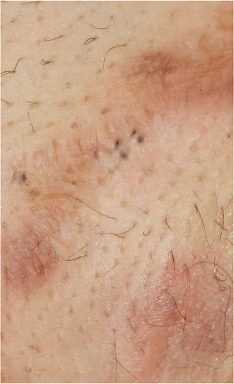 Hidradenitis Suppurativa Dermatologic Clinics