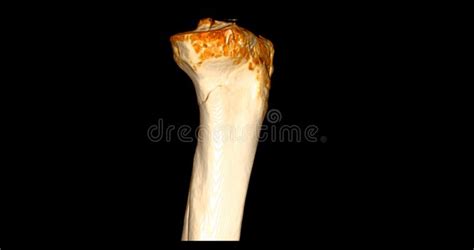 Fracture Of The Tibia Two Types Of Fracture Stock Illustration Illustration Of Element