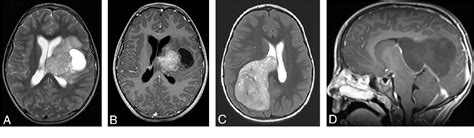 Figure 6 From Mri Features Of Histologically Diagnosed Supratentorial Primitive Neuroectodermal