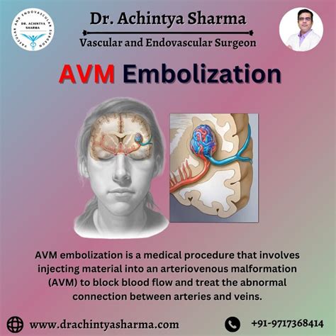 Avm Embolization As A New Treatment Due To Advances