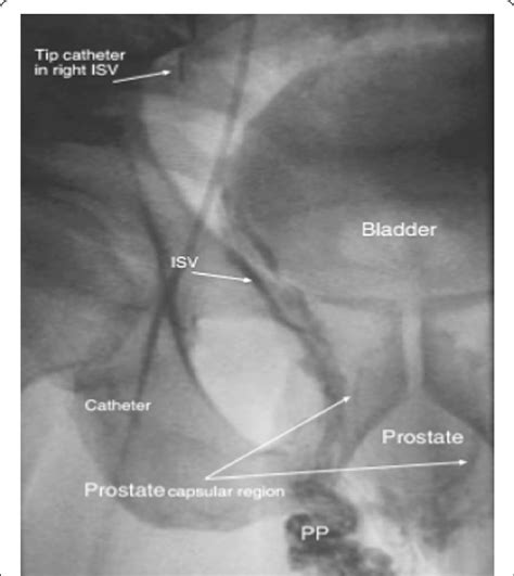 A Prostatic Capsular Contrast Blush Long Arrows Following Spermatic