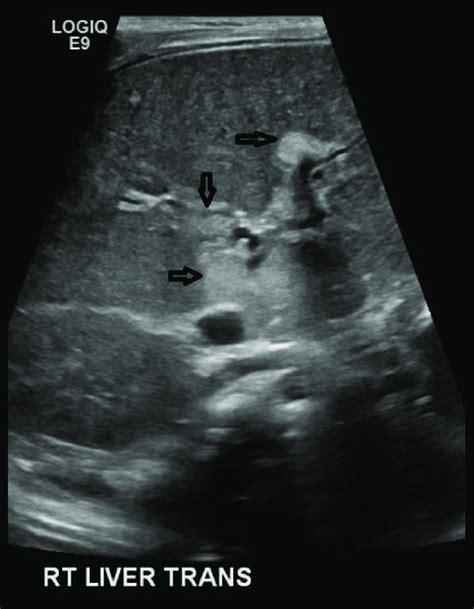 Transverse Sonographic Image Of The Liver In The Periportal Region Download Scientific Diagram
