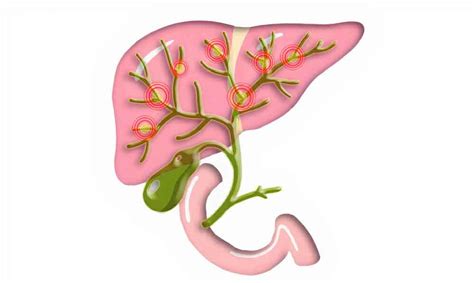 Primary Biliary Cholangitis PBC Primary Biliary Cirrhosis PBC