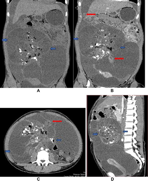 A Abdomen And Pelvic Non Contrast Computed Tomography CT Scan Download Scientific Diagram