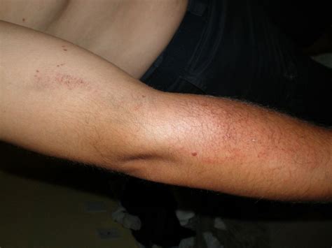 Road Rash is a Serious Bicycle Accident Injury - Ladah Law Firm