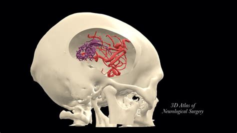 Right Temporal Craniotomy For Temporal Avm 3d Model By 3d Atlas Of Neurological Surgery
