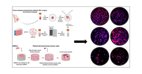 Evaluating Breast Cancer Patient Specific Metastasis Severity At Bone